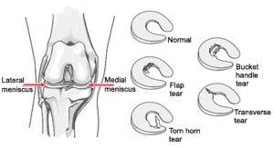 Meniscus Tear & Injury Overview, Signs & Symptoms